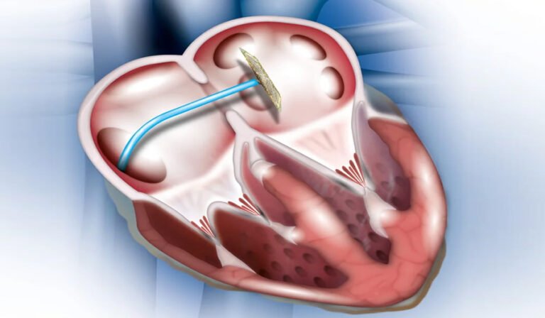 Device Closure (ASD, PDA) | Dr Sai Teja Baratam
