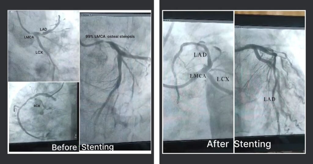 High-Risk LMCA Stenting: Successful 99% Ostial Lesion Case - Dr Sai ...